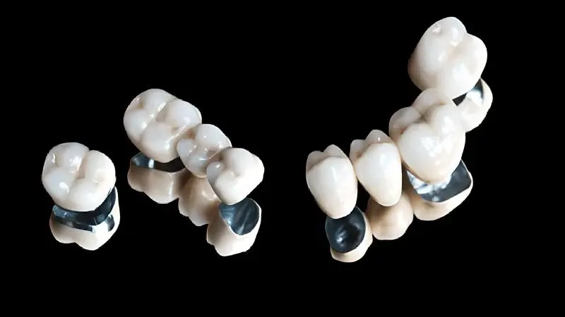 Răng sứ Titan là gì? Ưu điểm, nhược điểm khi bọc răng sứ Titan